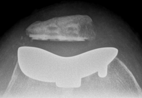 Patellofemoral Arthroplasty | The Bone School